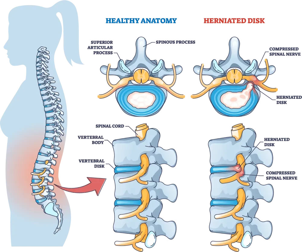 Disc Therapy – Dolan Chiropractic